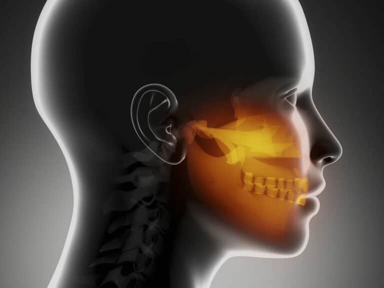 Temporomandibular Joint Dysfunction (TMJ)